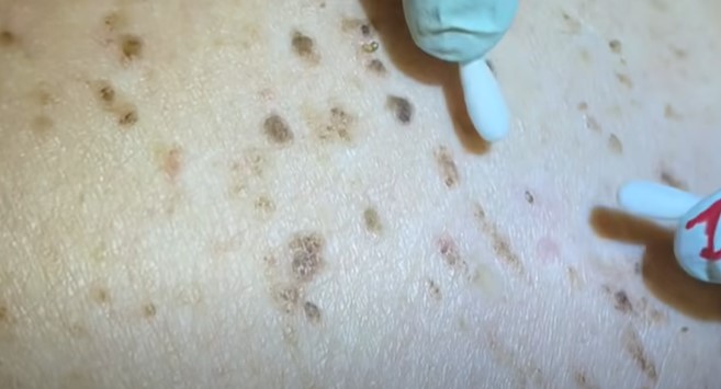 Blackhead Extractions And Cyst Excision Viral On The Web Now
